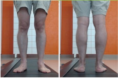 Todo sobre el pie plano - Martha Debayle